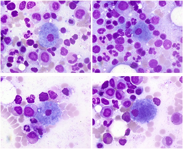 Interesting Bone Marrow Finding in a Patient With Splenomegaly | The ...